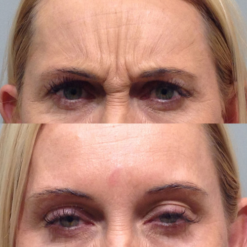 Botox & Lip Fillers | Illumé Laser & Skin Med Spa | Indiana